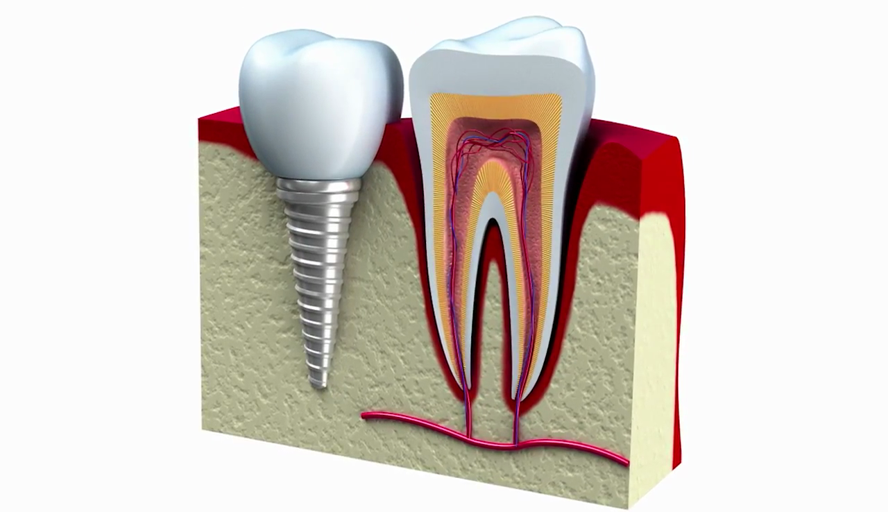 Dental Implants - Los Algodones, Baja California, Mexico