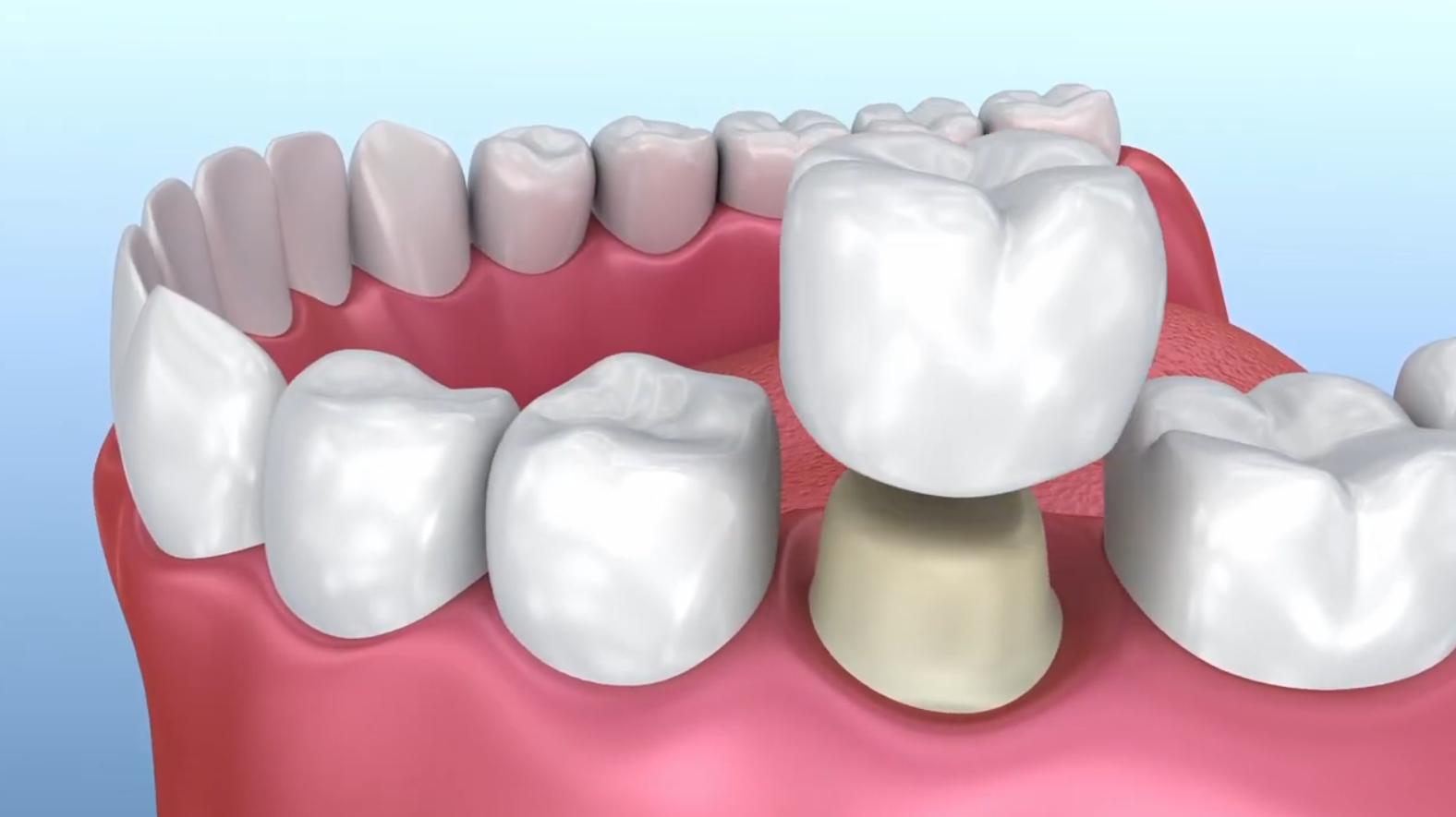 Dental Crowns Austin, TX - 38th Street Dental