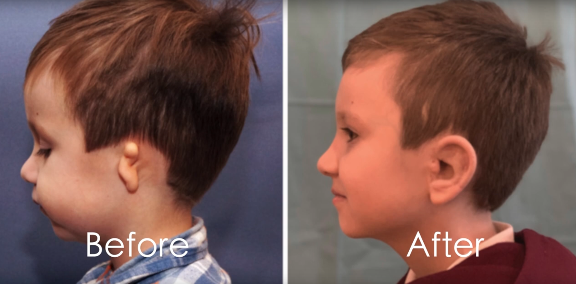 Newborn Microtia Beverly Hills, CA - Reinisch Plastic Surgery